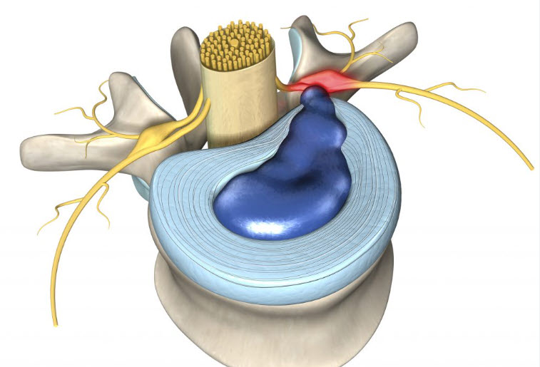 اختلال داخلی دیسک (internal disc disruption) - تسکین